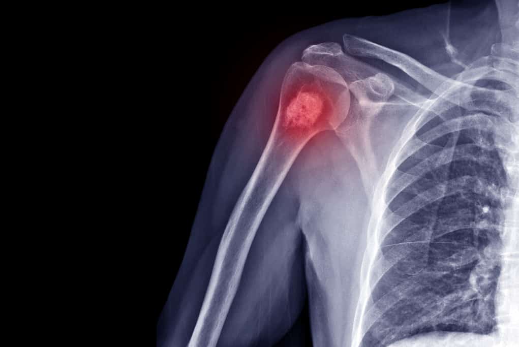 Orthopaedic oncology part 2: Diagnosis, staging, principles of biopsy ...